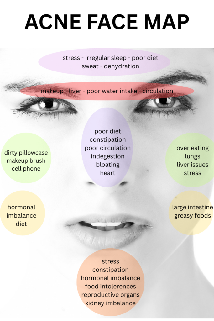 Acne Face Map: Why Your Breakouts Keep Coming Back in the Same Spot ...